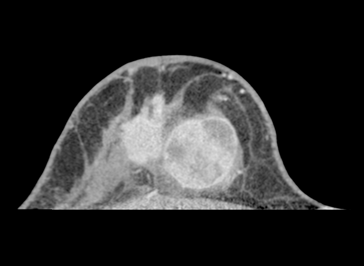 临床病历 - AB-CT – Advanced Breast-CT